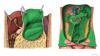 Retrohepatic IVC Injuries Evaluation and Assessment.pptx