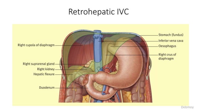 Retrohepatic IVC Injuries Evaluation and Assessment.pptx