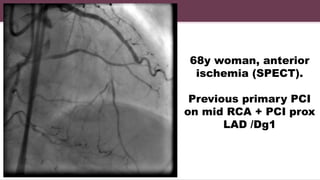 Retrograde microcather cannot cross the lesion: tips & tricks | PPT