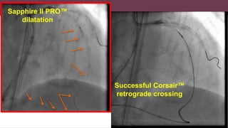 Retrograde microcather cannot cross the lesion: tips & tricks | PDF