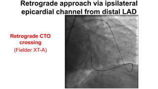 Retrograde microcather cannot cross the lesion: tips & tricks | PPT