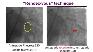 Retrograde microcather cannot cross the lesion: tips & tricks | PDF