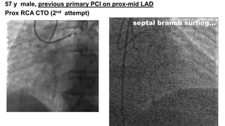 Retrograde microcather cannot cross the lesion: tips & tricks | PPT