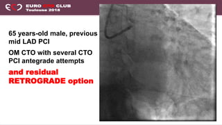 Retrograde microcather cannot cross the lesion: tips & tricks | PPT