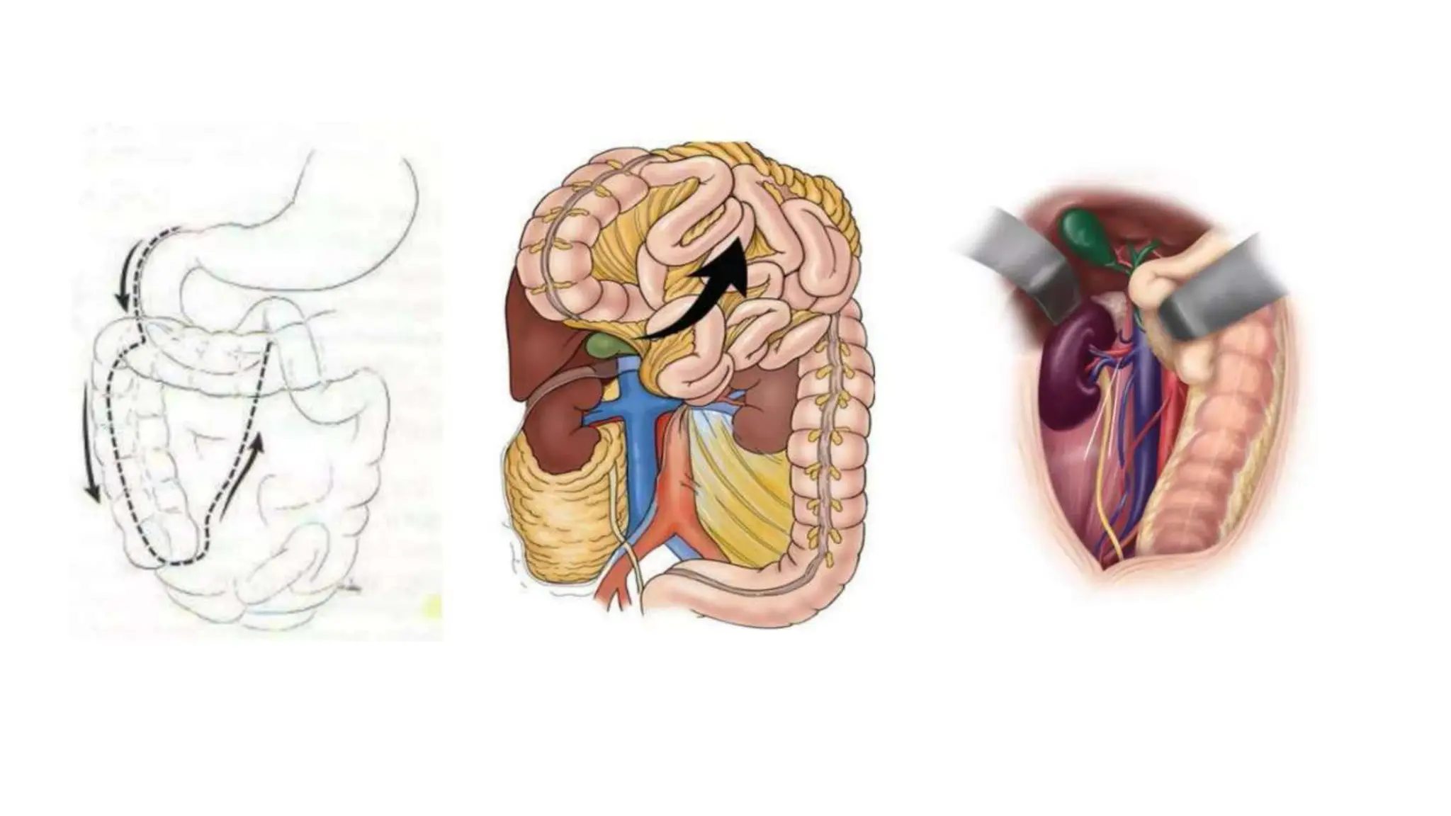 Retroperitoneal approach of abdomen.pptx