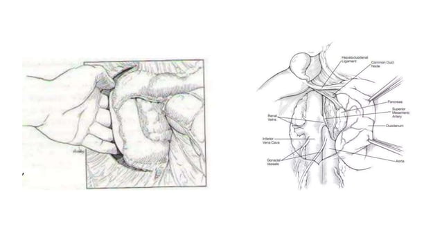 Retroperitoneal approach of abdomen.pptx