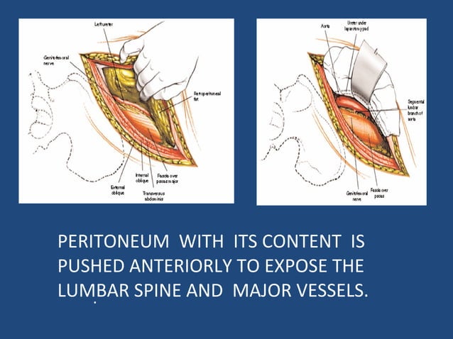 Retroperitoneal approach to the lumbar spine1 | PPT