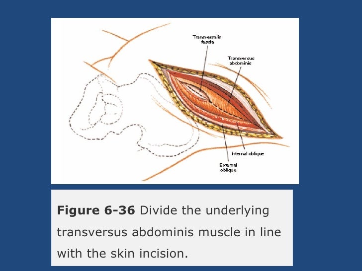 Retroperitoneal approach to the lumbar spine1