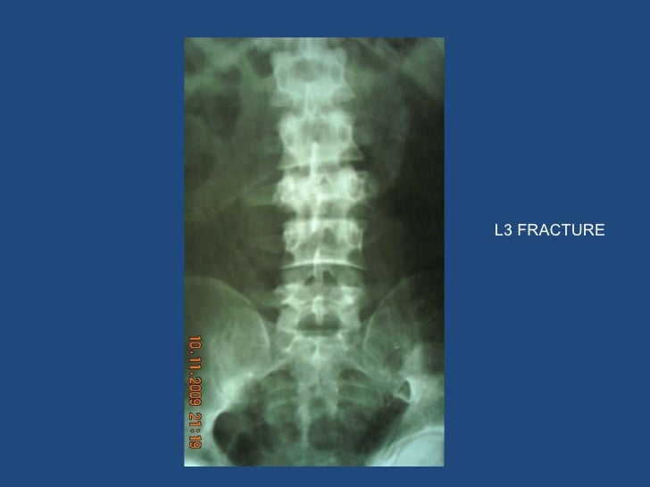 Retroperitoneal Approach To The Lumbar Spine1