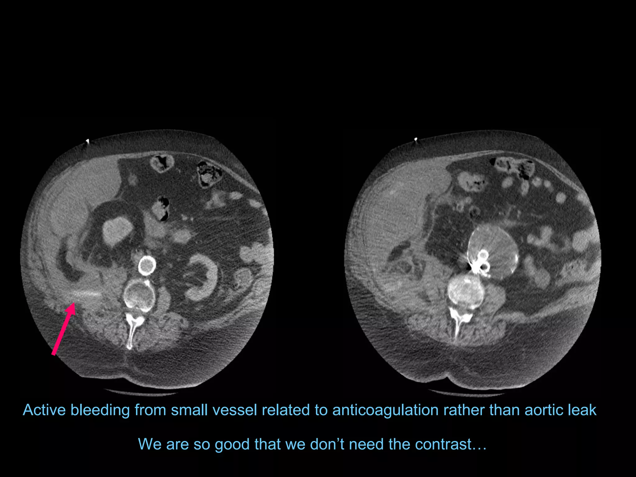 Radiology Rounds: Retroperitoneal Bleeds | PPT