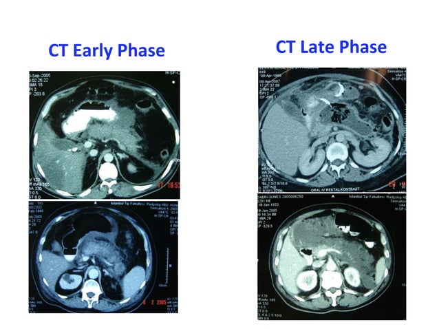 Retroperitoneal endoscopic necrosectomy | PPT | Digestive Disorders ...