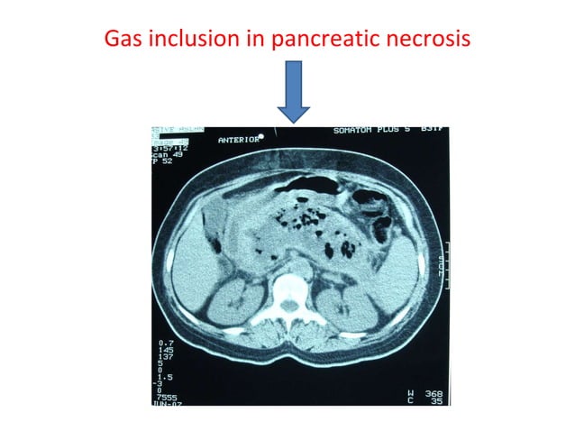 Retroperitoneal endoscopic necrosectomy | PPT | Digestive Disorders ...