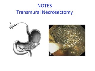 Retroperitoneal endoscopic necrosectomy | PPT