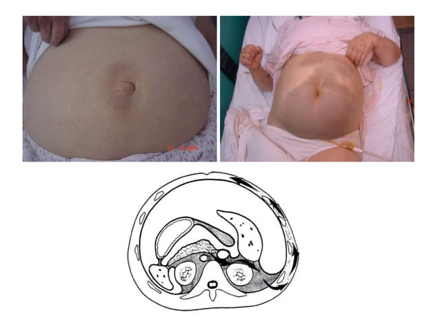 Retroperitoneal endoscopic necrosectomy | PPT | Digestive Disorders ...