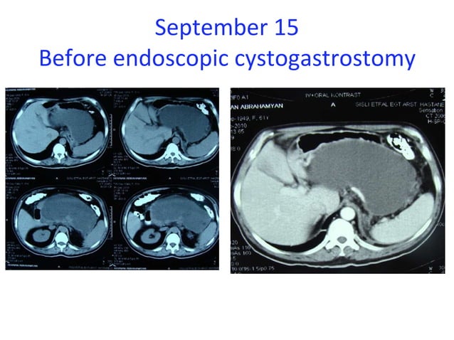 Retroperitoneal endoscopic necrosectomy | PPT | Digestive Disorders ...