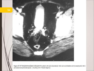 Retroperitoneal fibrosis | PDF