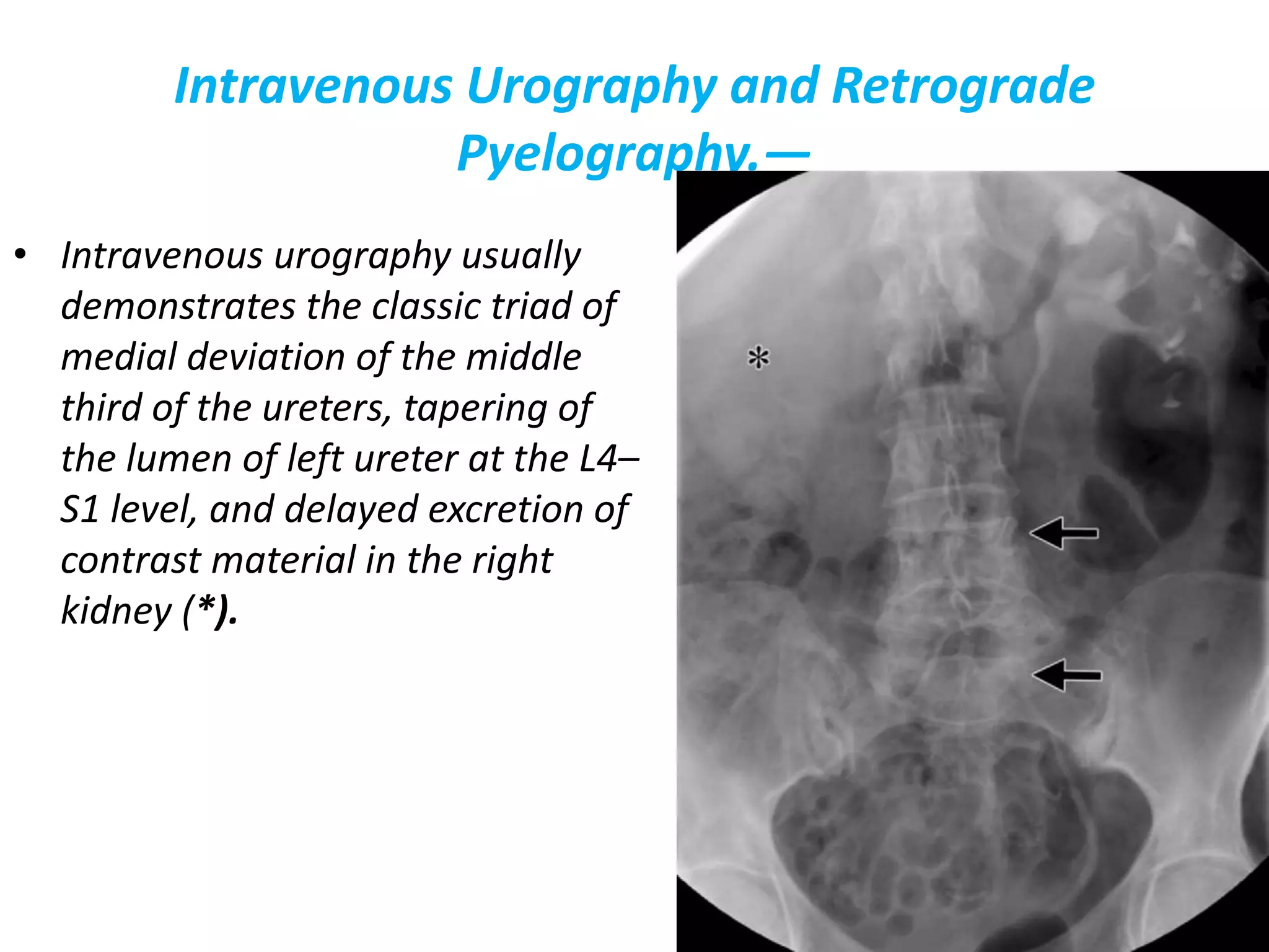 Retroperitoneal fibrosis radiology | PPTX