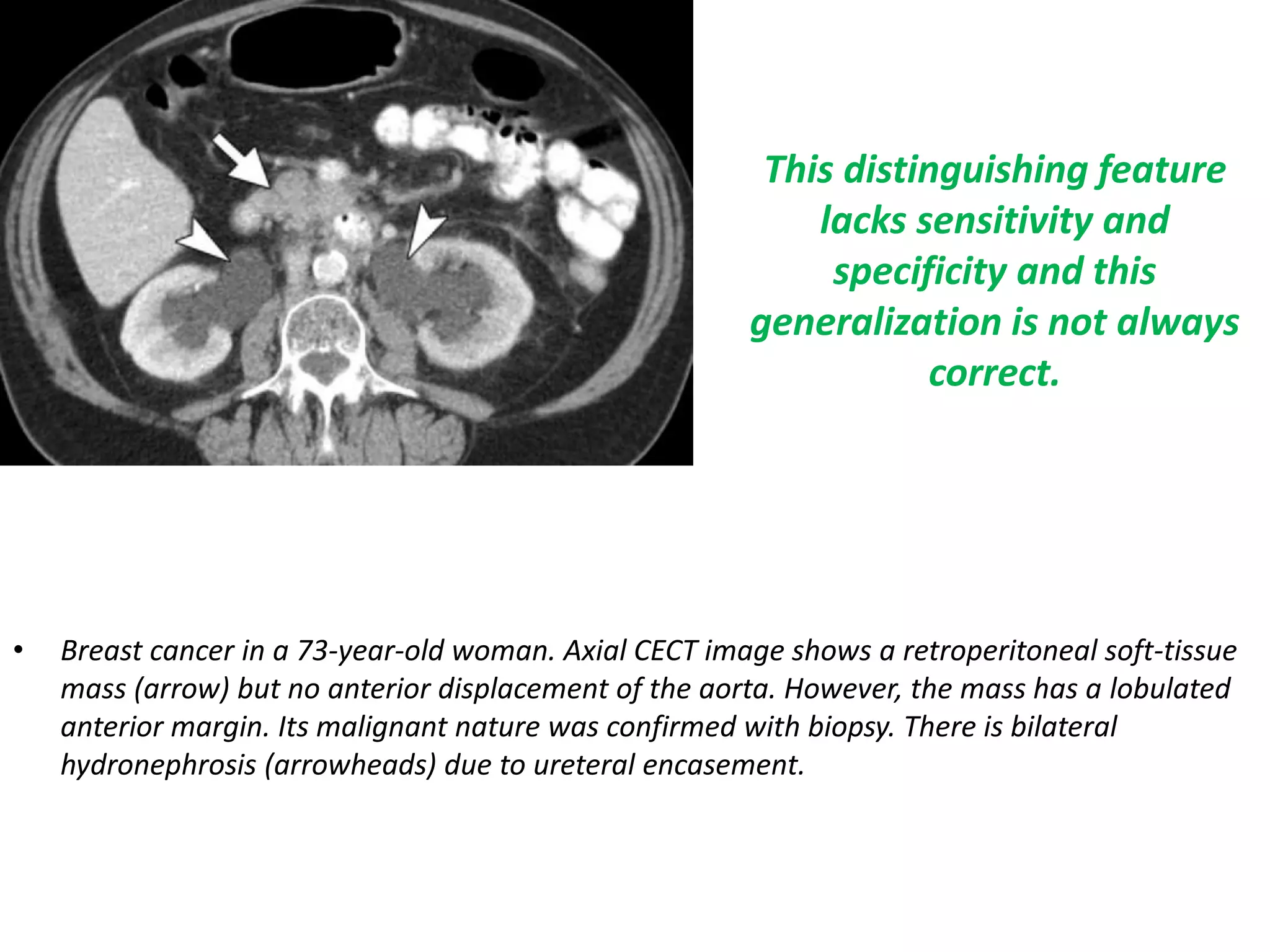 Retroperitoneal fibrosis radiology | PPTX