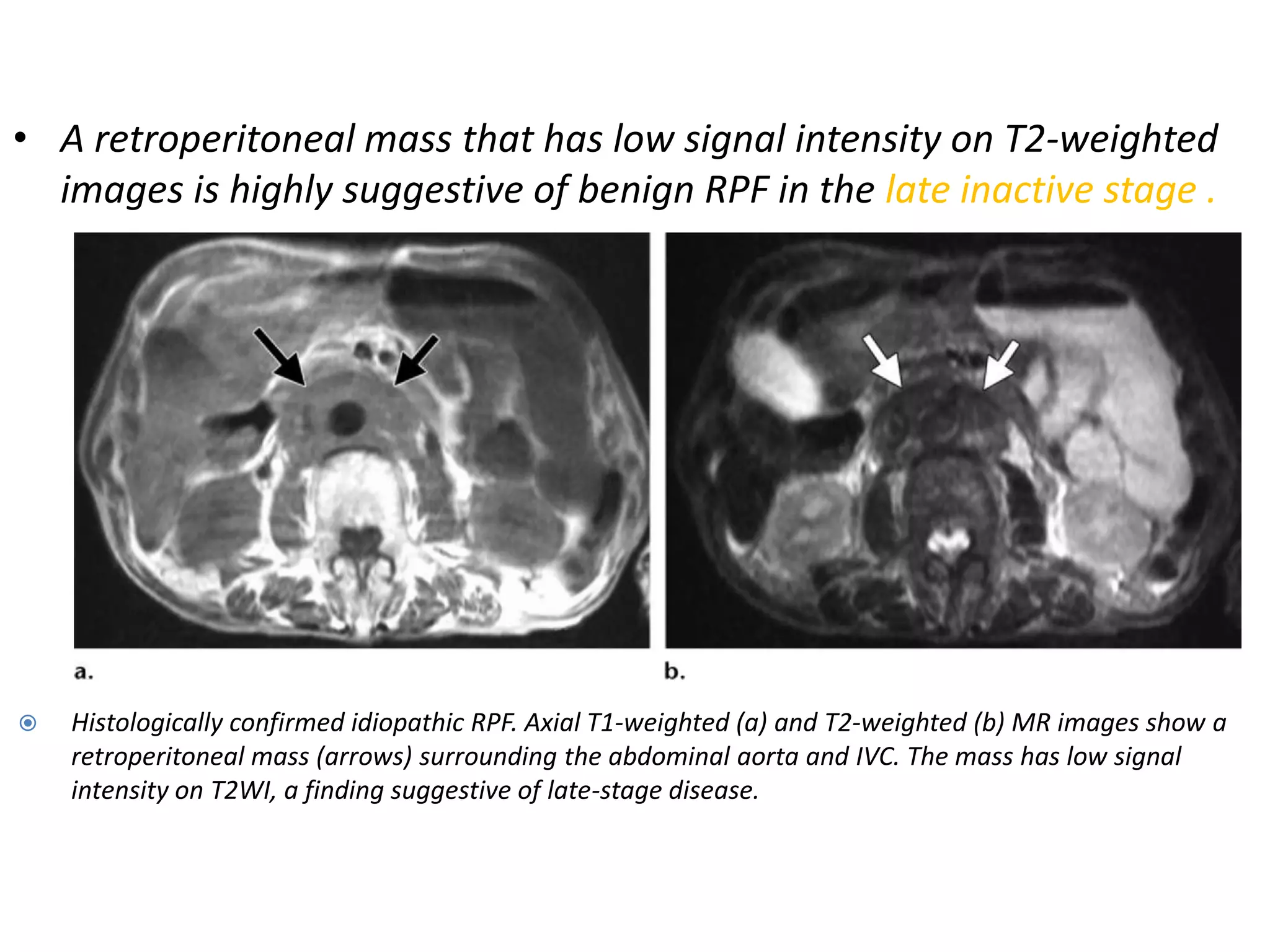 Retroperitoneal fibrosis radiology | PPTX
