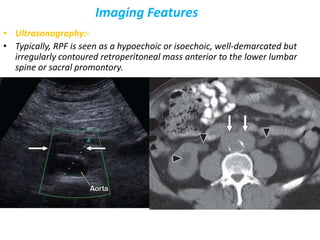 Retroperitoneal Fibrosis Radiopaedia
