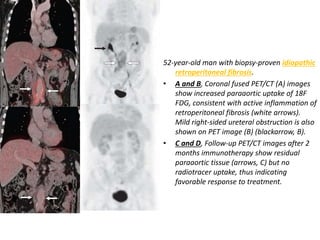 Retroperitoneal fibrosis radiology | PPTX