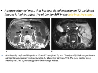 Retroperitoneal Fibrosis Ultrasound