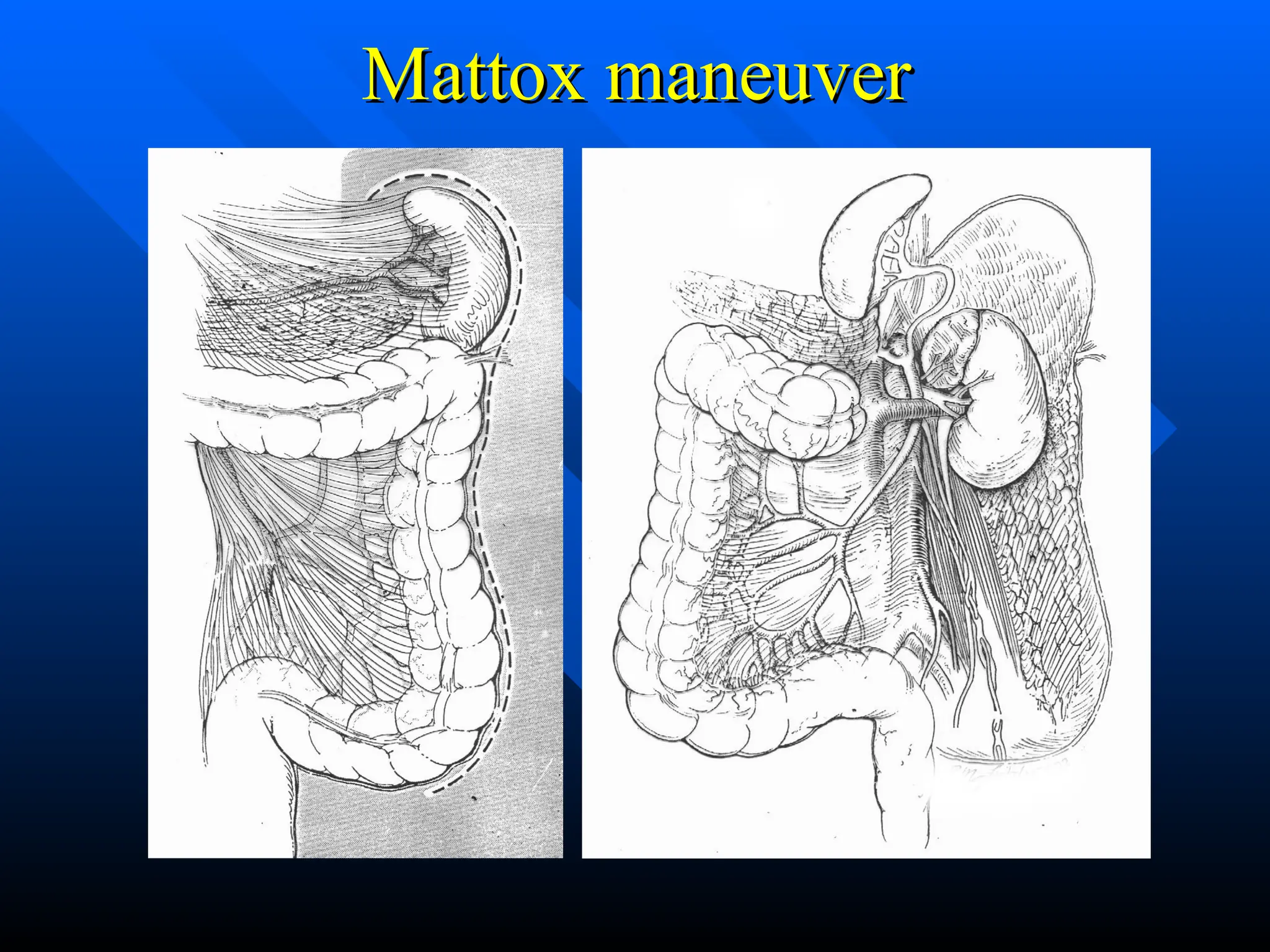 Retroperitoneal Hematoma causes and management the lect.ppt