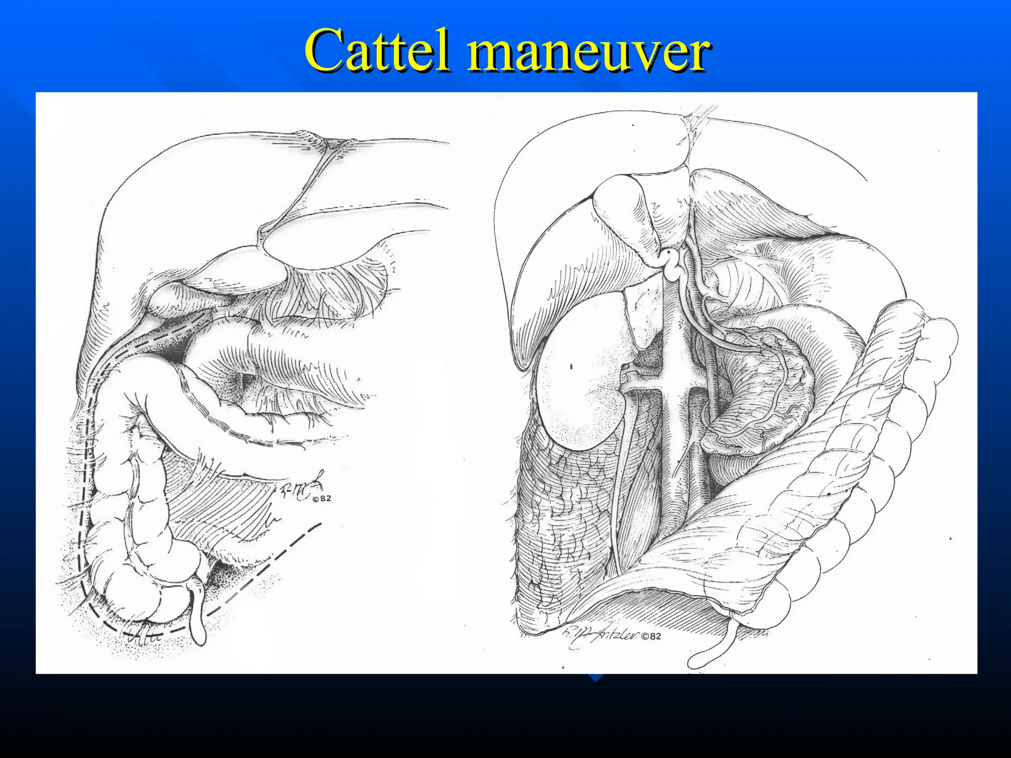 Retroperitoneal Hematoma causes and management the lect.ppt