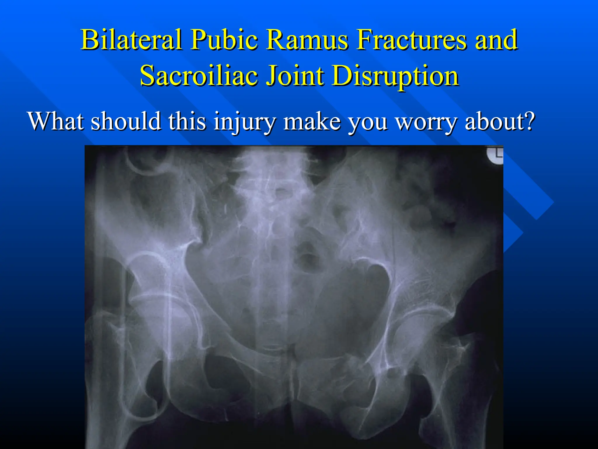 Retroperitoneal Hematoma causes and management the lect.ppt