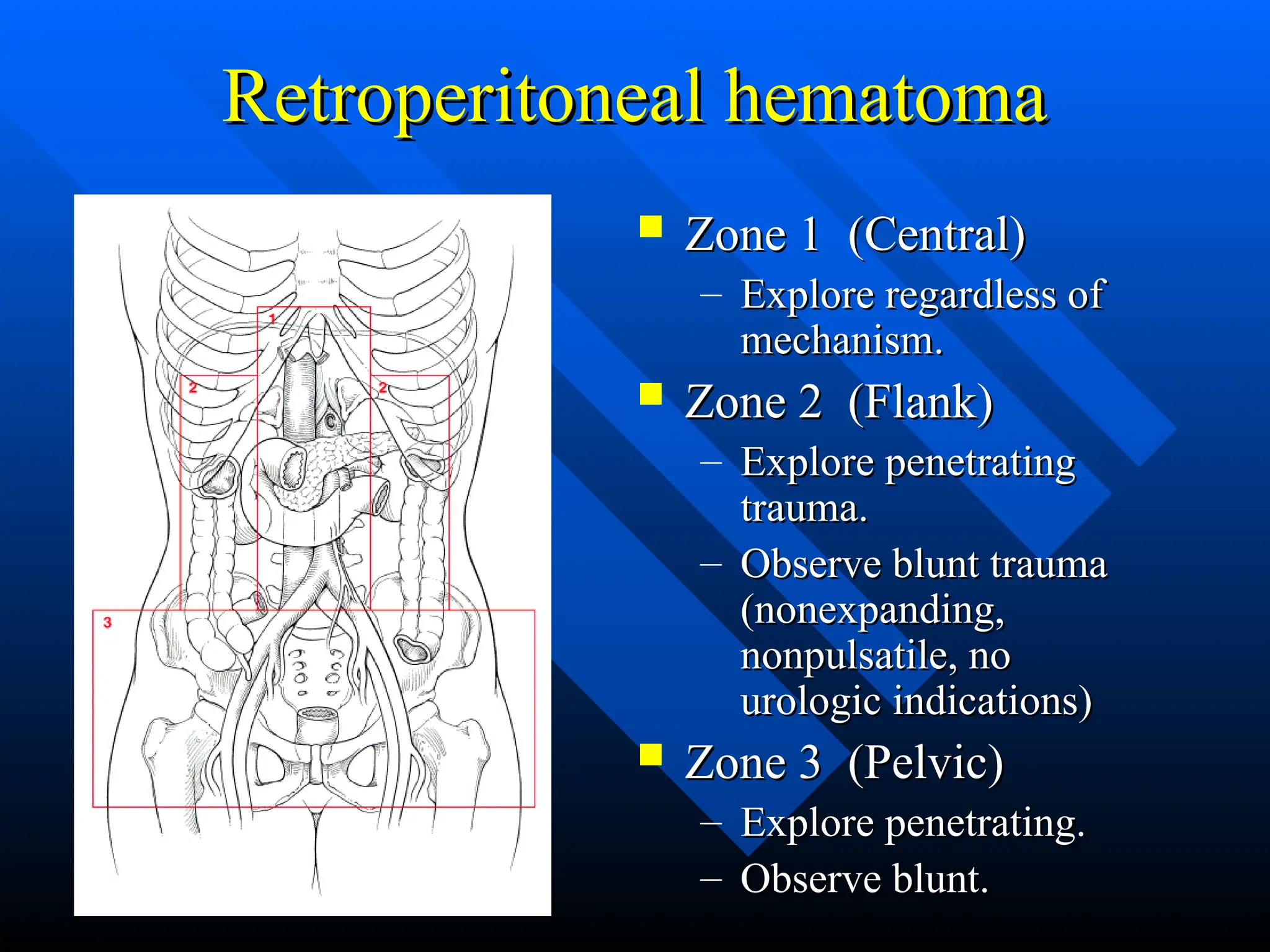 Retroperitoneal Hematoma causes and management the lect.ppt