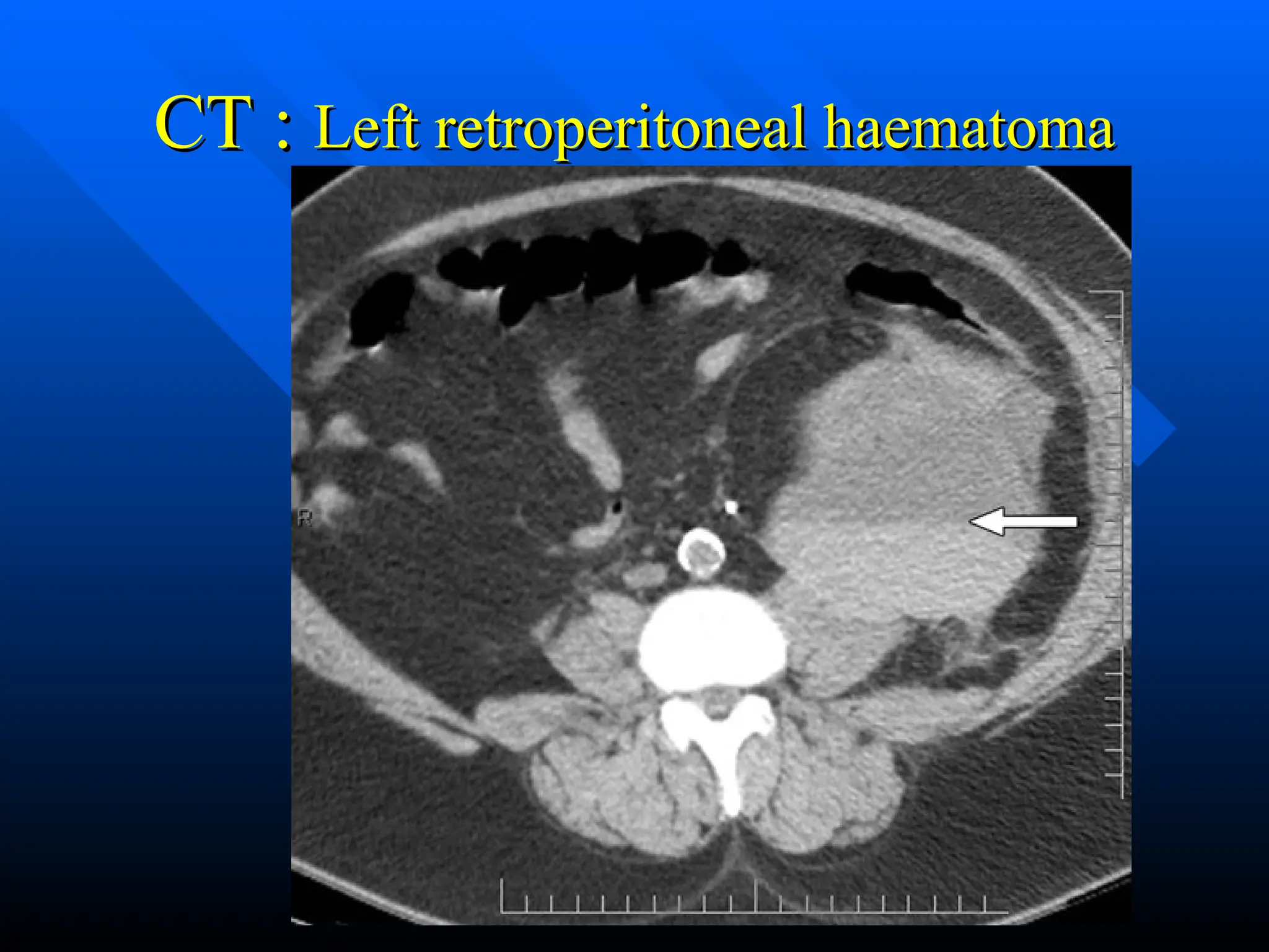 Retroperitoneal Hematoma causes and management the lect.ppt