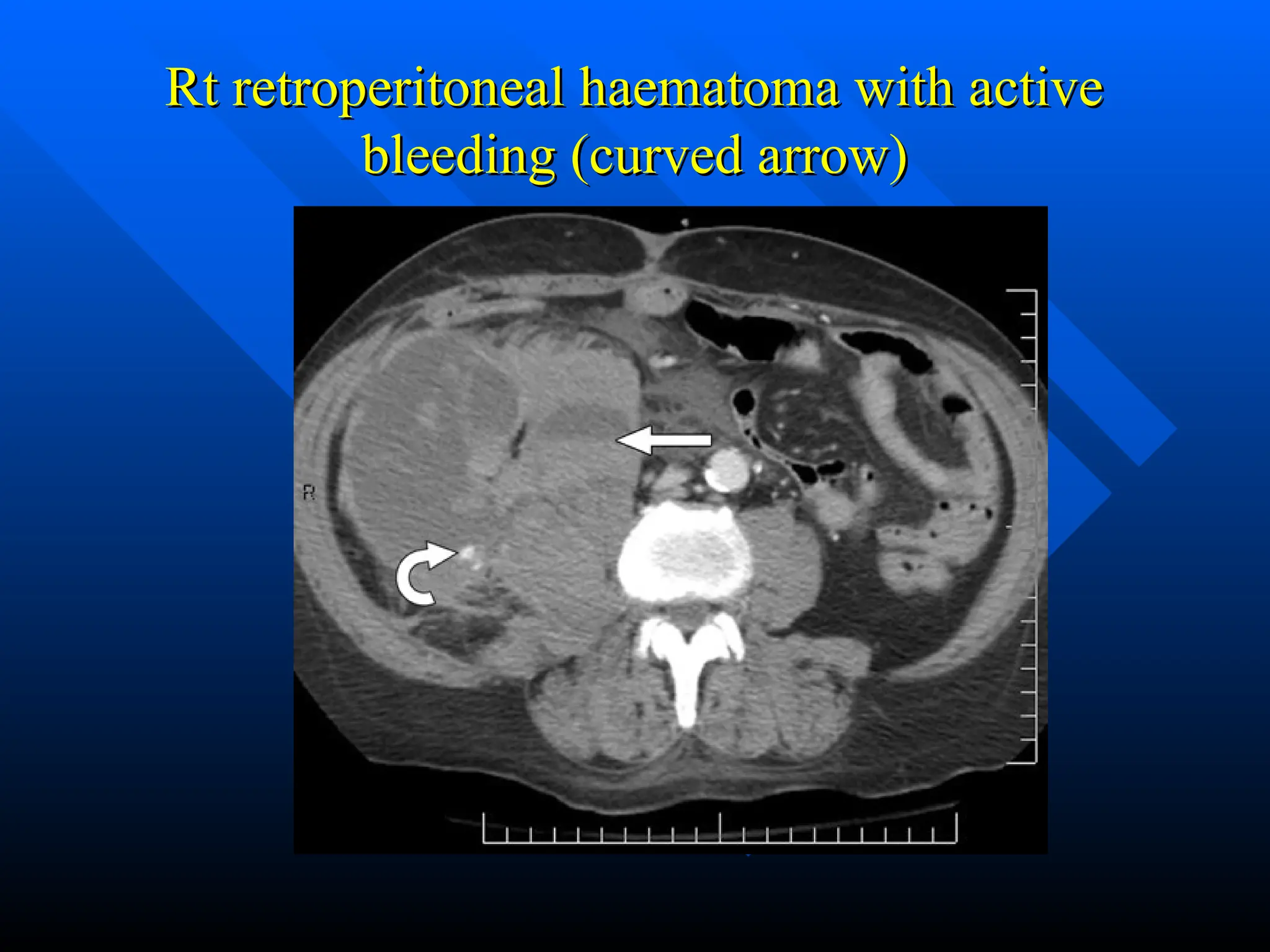 Retroperitoneal Hematoma causes and management the lect.ppt