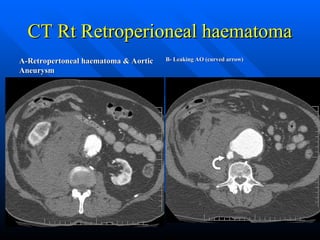 Retroperitoneal Hematoma causes and management the lect.ppt