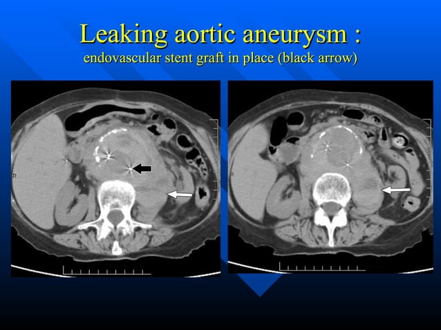 Retroperitoneal Hematoma causes and management the lect.ppt