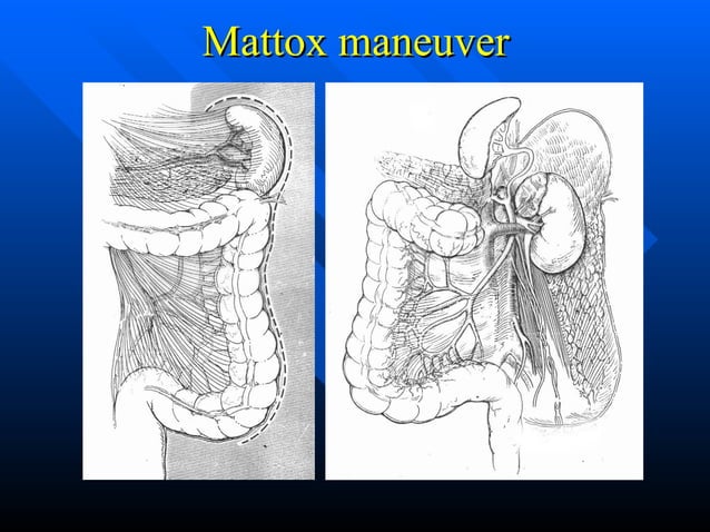 Retroperitoneal Hematoma causes and management the lect.ppt