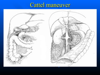 Retroperitoneal Hematoma causes and management the lect.ppt