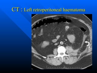 Retroperitoneal Hematoma causes and management the lect.ppt