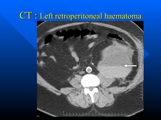 Retroperitoneal Hematoma causes and management the lect.ppt