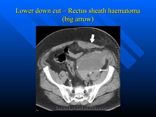 Retroperitoneal Hematoma causes and management the lect.ppt