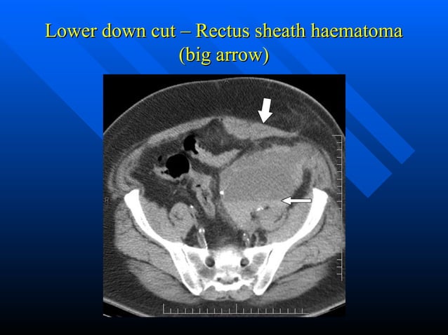 Retroperitoneal Hematoma causes and management the lect.ppt