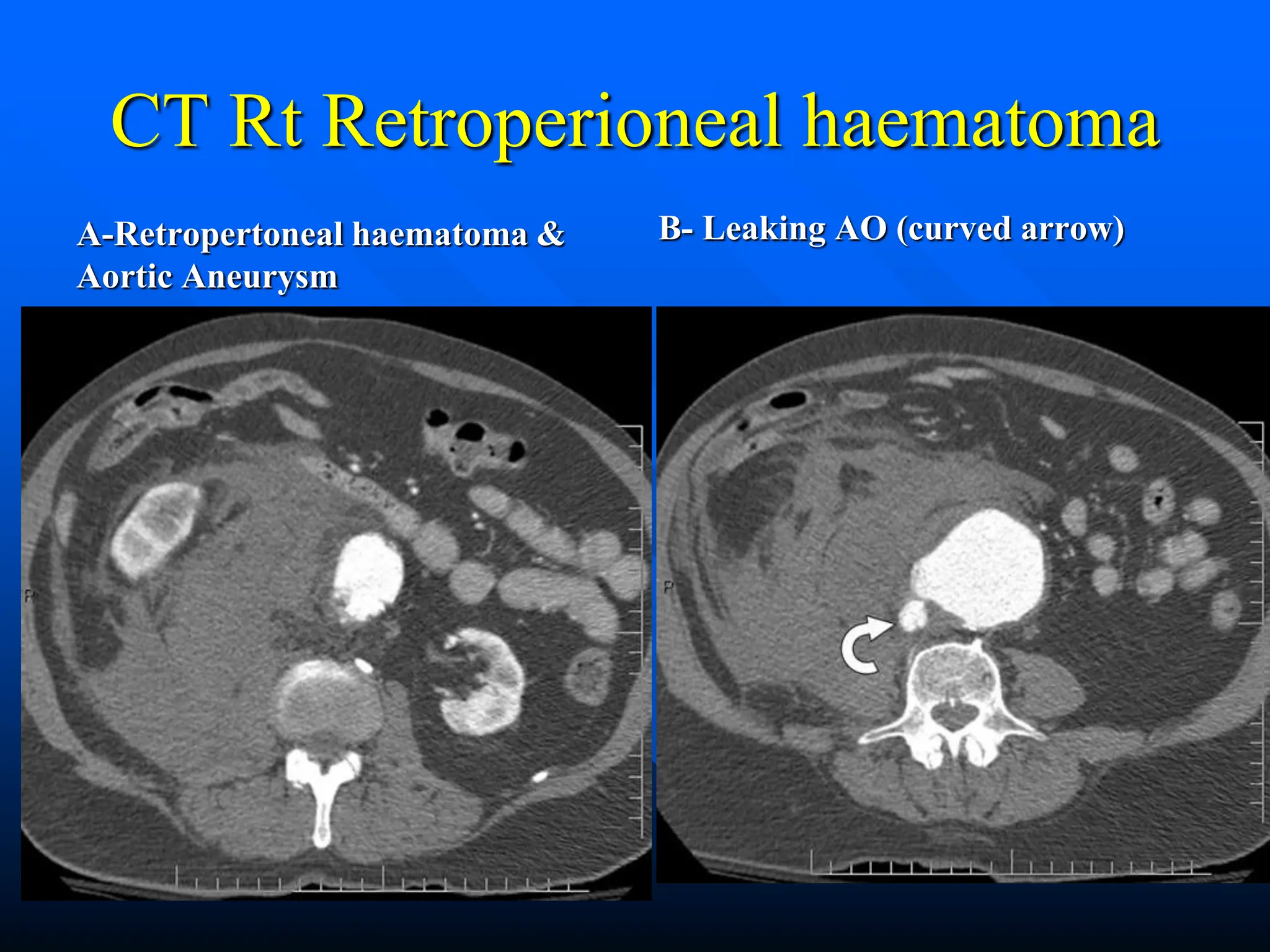 Retroperitoneal Hematoma types and management the lect.ppt