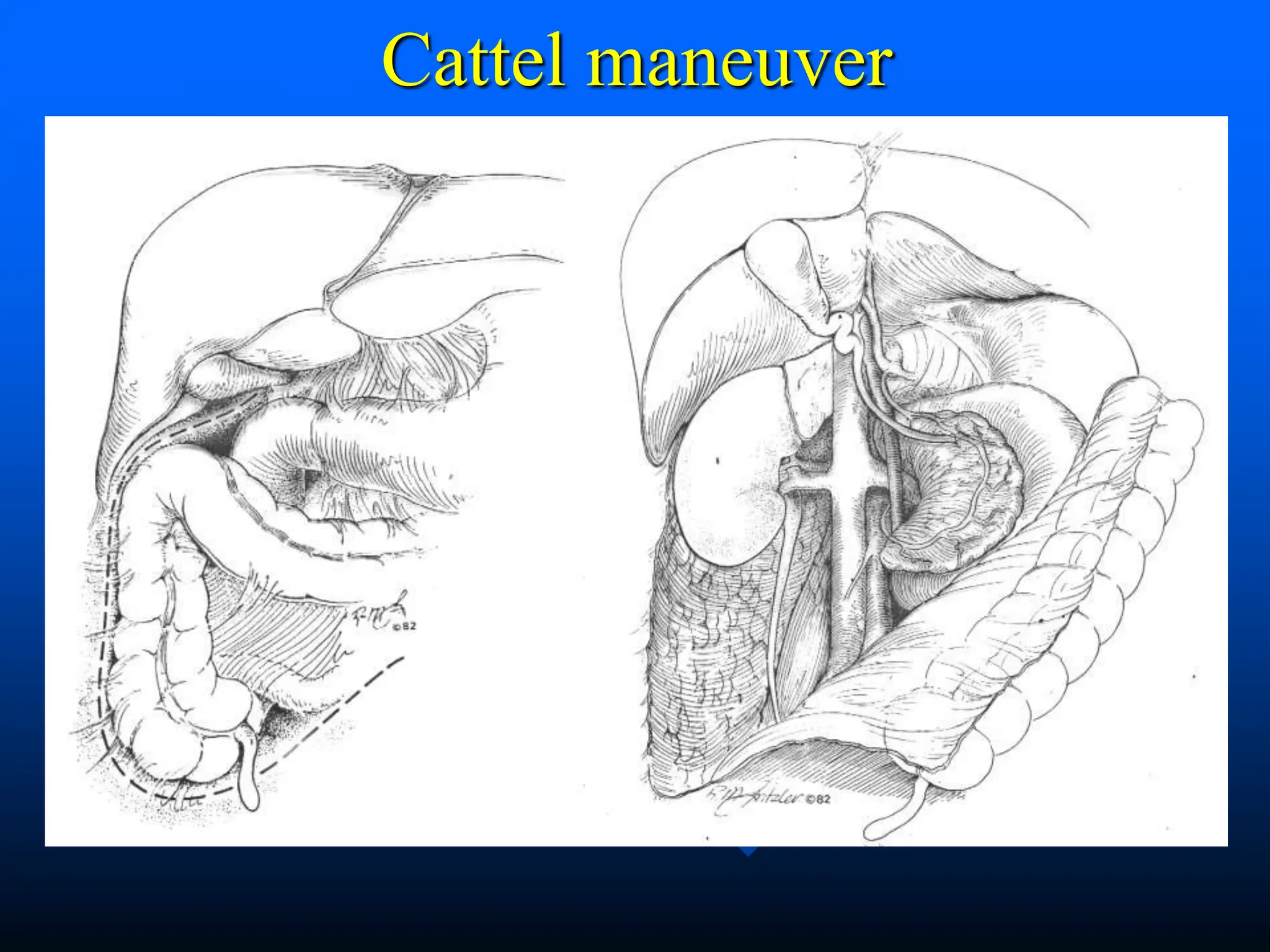 Retroperitoneal Hematoma types and management the lect.ppt