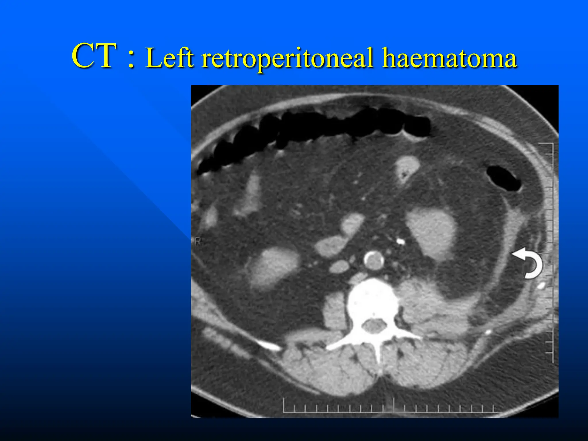 Retroperitoneal Hematoma types and management the lect.ppt