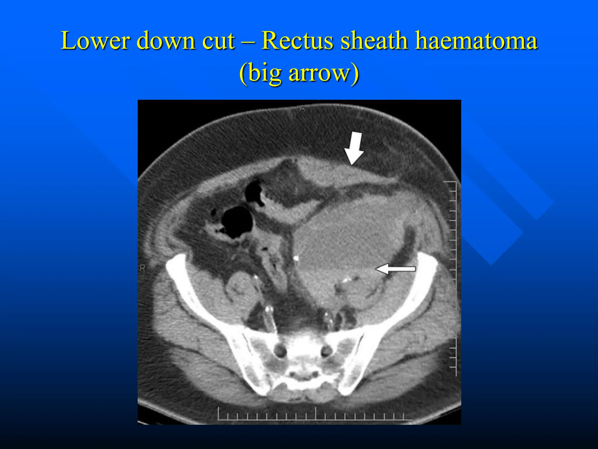 Retroperitoneal Hematoma types and management the lect.ppt
