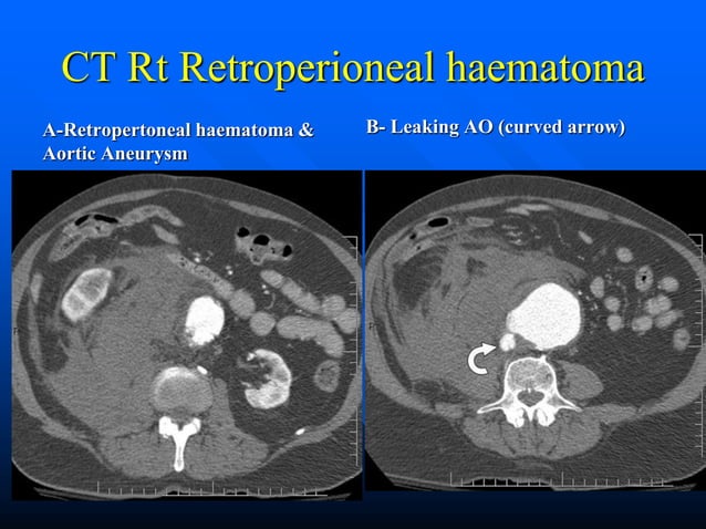 Retroperitoneal Hematoma types and management the lect.ppt