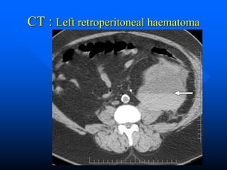 Retroperitoneal Hematoma types and management the lect.ppt