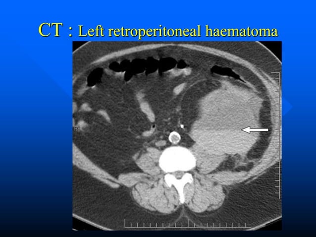 Retroperitoneal Hematoma types and management the lect.ppt