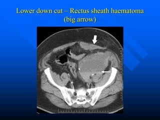 Retroperitoneal Hematoma types and management the lect.ppt