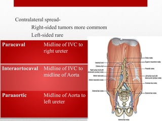 Retroperitoneal lymph node dissection kaushal | PPTX