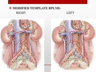 Retroperitoneal Lymph Nodes Anatomy